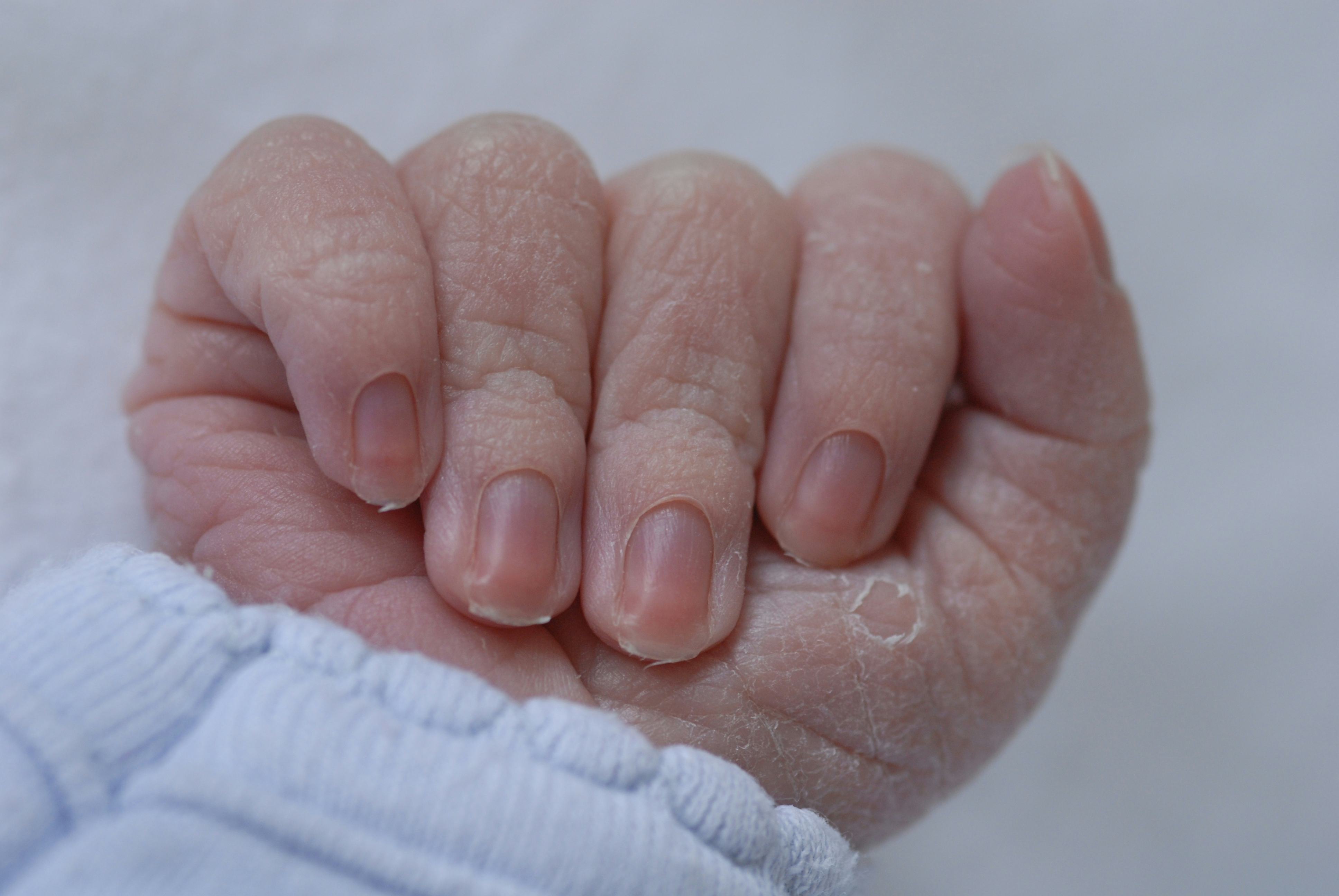 7 Signs of Frostbite In Babies That Should Be Noticed As Early As Possible