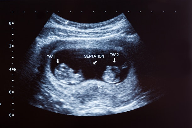 Do Twins Really Eat Each Other In The Womb Heres What The Experts Say